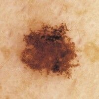 Black ink spot Images - Altmeyers Encyclopedia - Department Dermatology