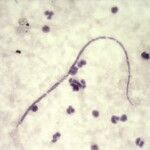 Mansonelliasis - Altmeyers Enzyklopädie - Fachbereich Dermatologie