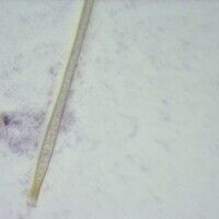 Mansonelliasis Bilder - Altmeyers Enzyklopädie - Fachbereich Dermatologie