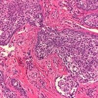 Lymphadenoma, cutaneous Images - Altmeyers Encyclopedia - Department ...
