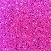 Neurothekeoma cellular Images - Altmeyers Encyclopedia - Department ...