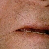 Keilexzision, multi-layer Images - Altmeyers Encyclopedia - Department ...