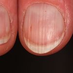 Splinter hemorrhages - Altmeyers Encyclopedia - Department Dermatology