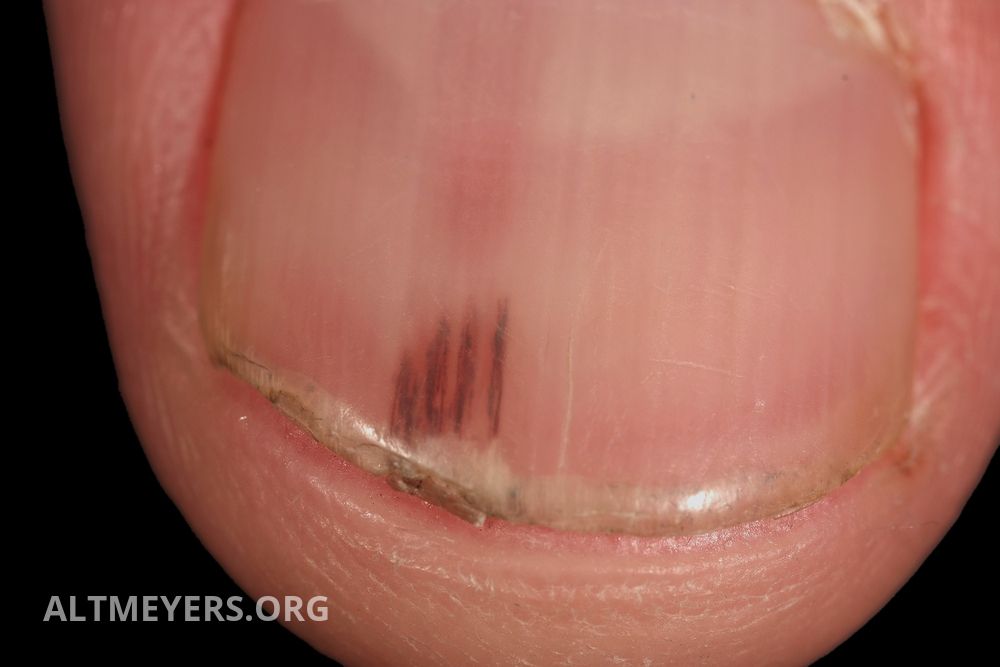 Splinter Hemorrhages Endocarditis