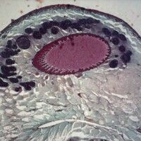 Paragonimiasis Images - Altmeyers Encyclopedia - Department Dermatology