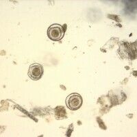 Hymenolepiasis Images - Altmeyers Encyclopedia - Department Dermatology