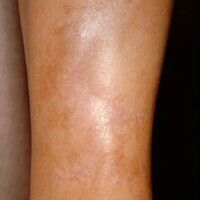 Rhomboid-to-w transposition flap plastic Images - Altmeyers ...