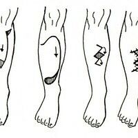 Skin tension lines Images - Altmeyers Encyclopedia - Department Dermatology