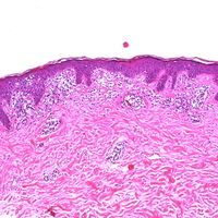 Mycosis fungoides Patch-Stadium Bilder - Altmeyers Enzyklopädie ...