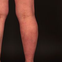 Acrodermatitis chronica atrophicans Images - Altmeyers Encyclopedia ...