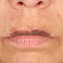 Urticaria control test - Altmeyers Encyclopedia - Department Dermatology