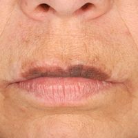 Argyria Images - Altmeyers Encyclopedia - Department Dermatology