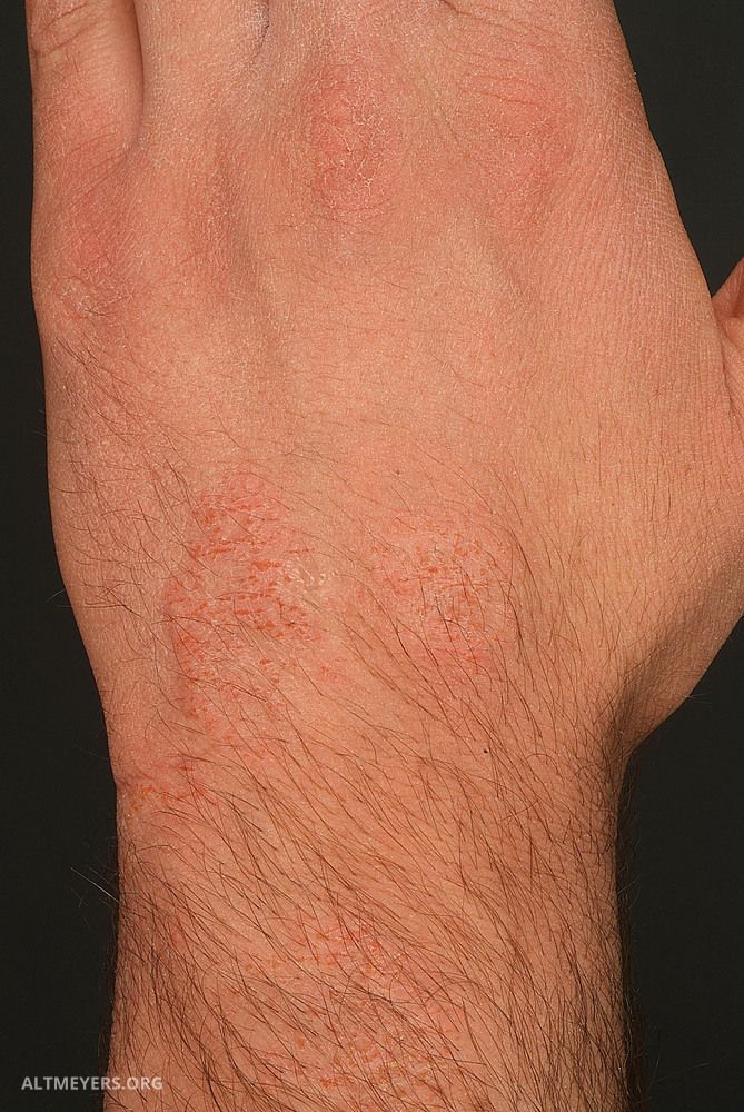 Lichenification Hand