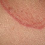 Erythema gyratum repens - Altmeyers Encyclopedia - Department Dermatology