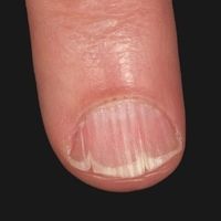 Brachyonychie Bilder - Altmeyers Enzyklopädie - Fachbereich Dermatologie