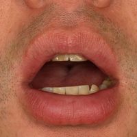 Cheilitis granulomatosa Images - Altmeyers Encyclopedia - Department ...