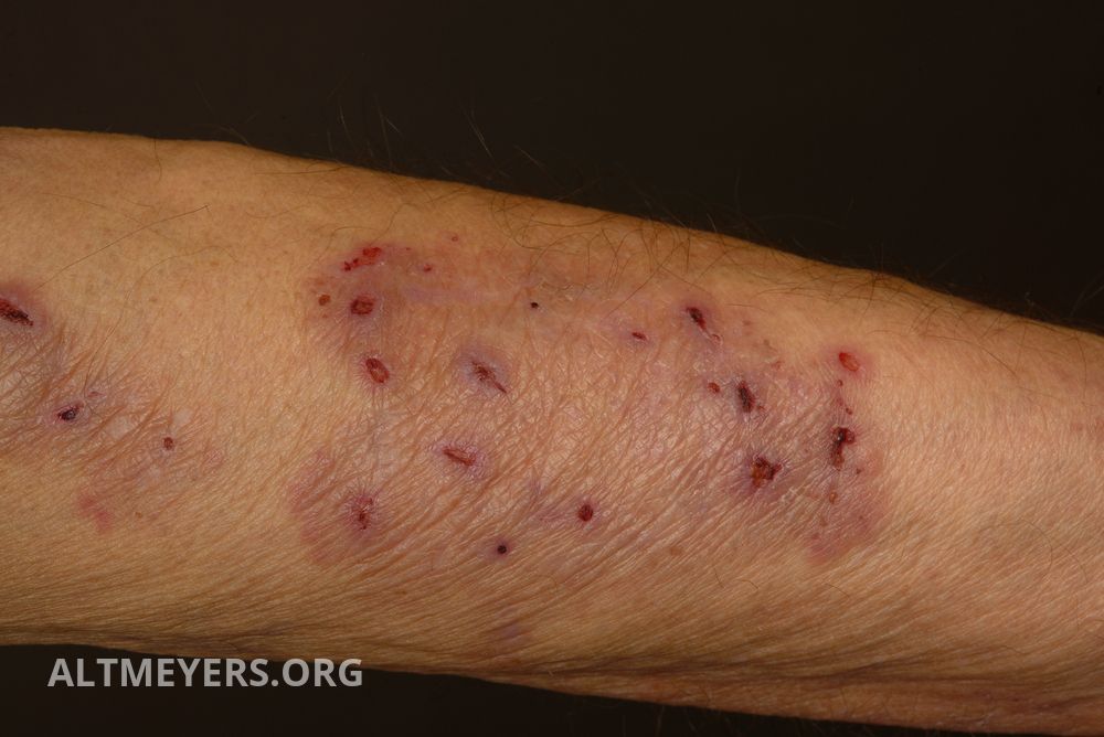 Lichen Ruber Moniliformis On Wholesale | www.pinnaxis.com