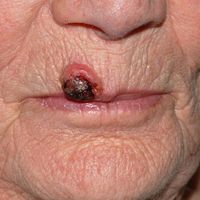 Lip carcinoma Images - Altmeyers Encyclopedia - Department Dermatology
