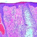 Mycosis fungoides (Übersicht) - Altmeyers Enzyklopädie - Fachbereich ...