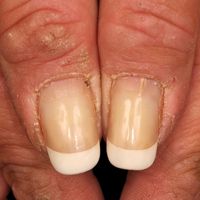 Psoriasis der Nägel Images - Altmeyers Encyclopedia - Department ...