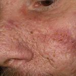 Rhinophym - Altmeyers Enzyklopädie - Fachbereich Dermatologie
