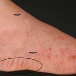 Tinea pedis moccasin type - Altmeyers Encyclopedia - Department Dermatology