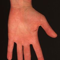 Erythema palmare et plantare symptomaticum Bilder - Altmeyers ...