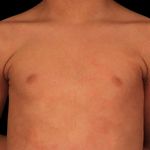 Virus exanthema (overview) - Altmeyers Encyclopedia - Department ...