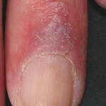 Chilblain-Lupus - Altmeyers Enzyklopädie - Fachbereich Dermatologie