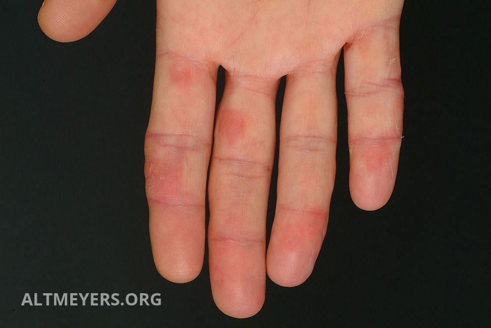 Lupus Pernio Hands