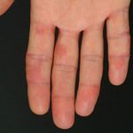 Chilblain-Lupus - Altmeyers Enzyklopädie - Fachbereich Dermatologie