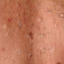 Bromoderm - Altmeyers Enzyklopädie - Fachbereich Dermatologie