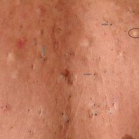 Komedo Bilder - Altmeyers Enzyklopädie - Fachbereich Dermatologie