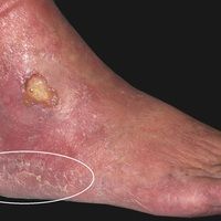 Ulcus cruris venosum Bilder - Altmeyers Enzyklopädie - Fachbereich ...