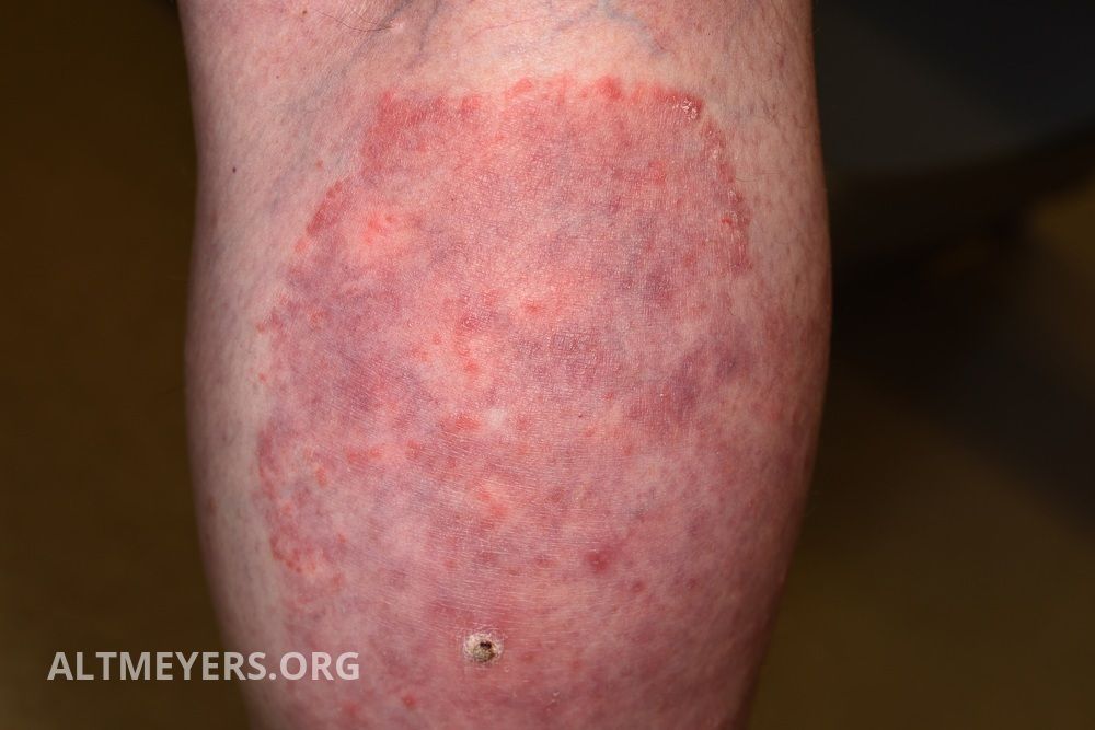 Tinea Corporis