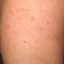 Lower leg pigmentation, hereditary atrophy associated with atrophy ...