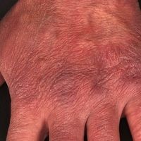 Acrodermatitis chronica atrophicans Images - Altmeyers Encyclopedia ...