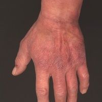 Acrodermatitis chronica atrophicans Images - Altmeyers Encyclopedia ...