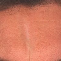 Scleroderma and coup de sabre Images - Altmeyers Encyclopedia ...