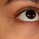 Syringom (Übersicht) - Altmeyers Enzyklopädie - Fachbereich Dermatologie