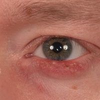 Rosazea okuläre Bilder - Altmeyers Enzyklopädie - Fachbereich Dermatologie