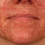 Periorale Dermatitis - Altmeyers Enzyklopädie - Fachbereich Dermatologie