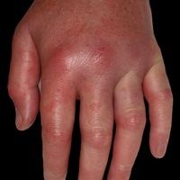 Angioödem Histamin-vermitteltes Bilder - Altmeyers Enzyklopädie ...