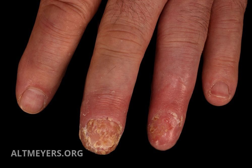 Acrodermatitis Continua Of Hallopeau