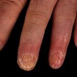 Acrodermatitis continua suppurativa - Altmeyers Enzyklopädie ...