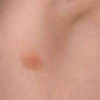 Xanthogranulom juveniles Bilder - Altmeyers Enzyklopädie - Fachbereich ...