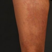 Scleroderma linear Images - Altmeyers Encyclopedia - Department Dermatology