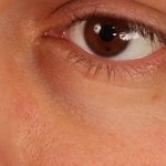 Syringome disseminierte - Altmeyers Enzyklopädie - Fachbereich Dermatologie