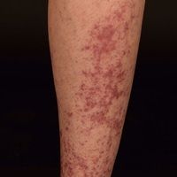 Vasculitis leukocytoclastic (non-iga-associated) Images - Altmeyers ...