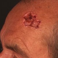 Basal cell carcinoma ulcerated Images - Altmeyers Encyclopedia ...